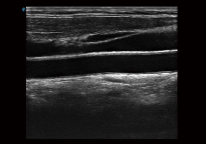 Panoramic Imaging SonoScape E2 PRO Portable Ultrasound Machine