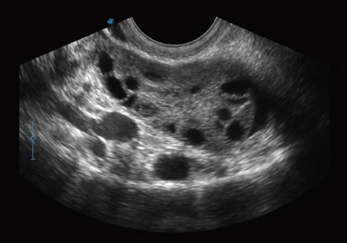 Panoramic Imaging SonoScape E2 PRO Portable Ultrasound Machine
